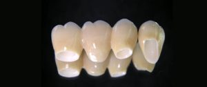 CAD CAM Crowns - Avant Dental