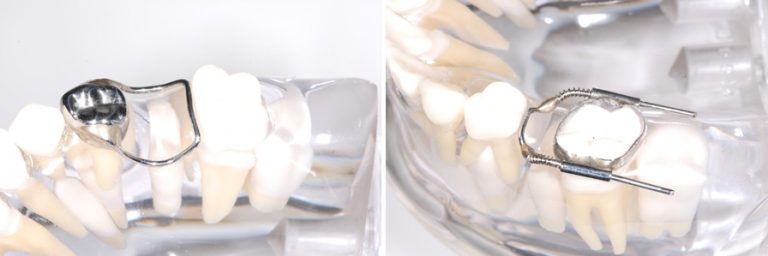 Teeth Space Maintainer | Best Orthodontic Treatment in Kolkata| Avant ...